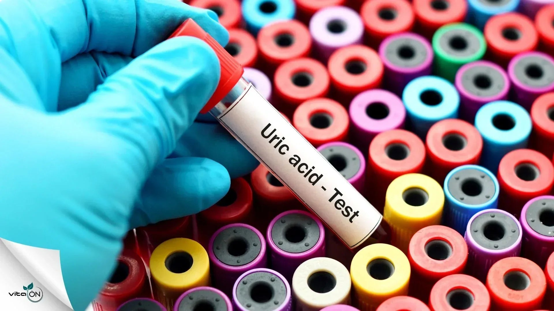 Urinezuur: symptomen van hoge en lage waarden – VitaOn